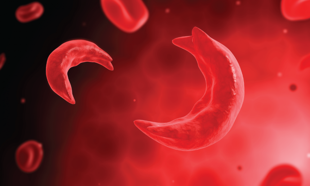 Epilepsy and Sickle Cell Disease: A Growing Dual Burden in Nigeria ...